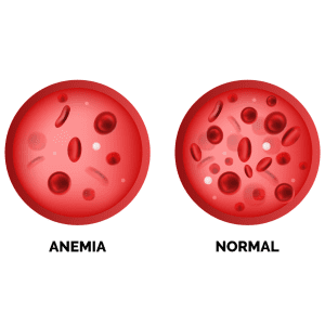 Understanding Anemia: Types & Charts