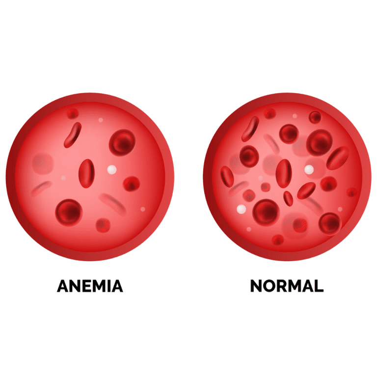 Understanding Anemia: Types & Charts
