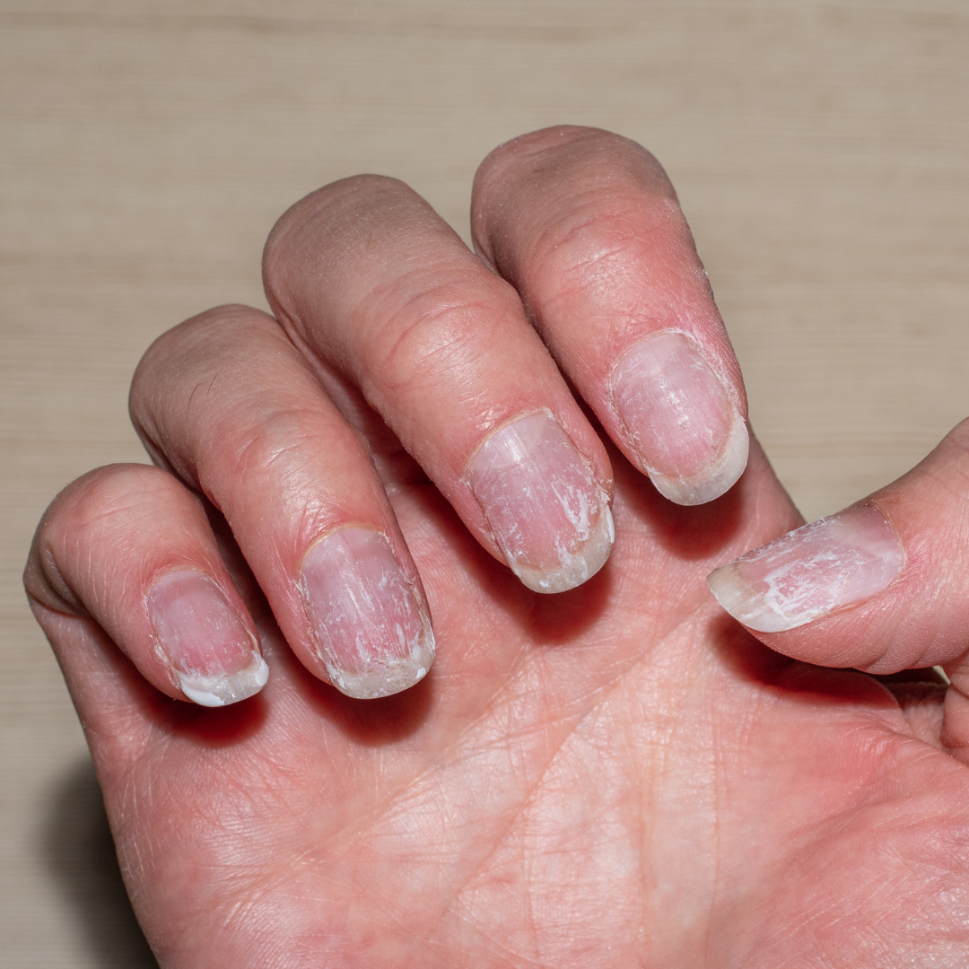 Iron Deficiency Nails